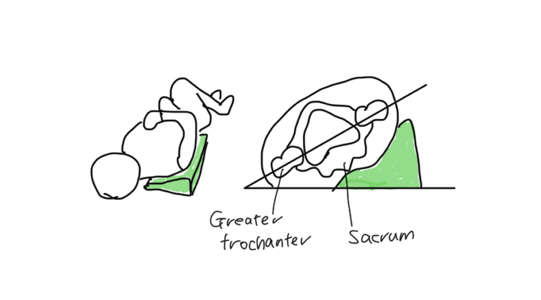 30-Degree Lateral Position: Hidden Risks & the Bananafit Cushion | 翻訳nurse